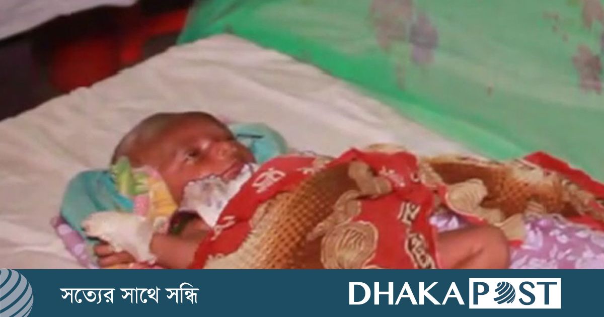 পাবনায় শিশুর ক্যানোলা খোলার সময় হাতের আঙ্গুল কেটে ফেলার অভিযোগ